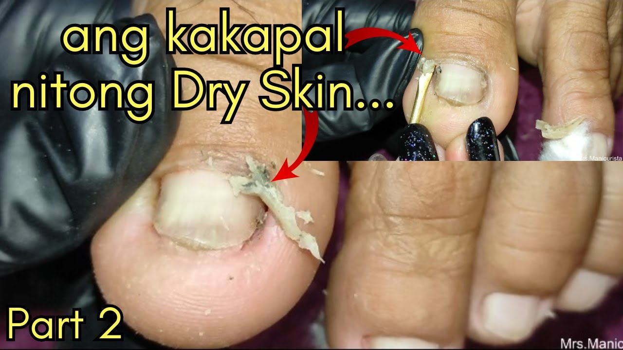 Vlog 762|Dry Skin/Ingrown Removal| PEDICURE 662 - YouTube