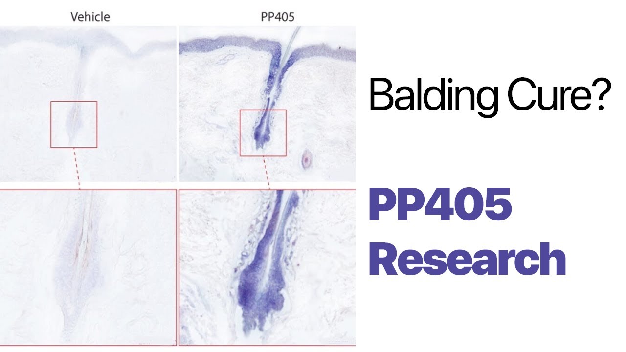 Balding Cure 2025? PP405 [New Research Update] - YouTube