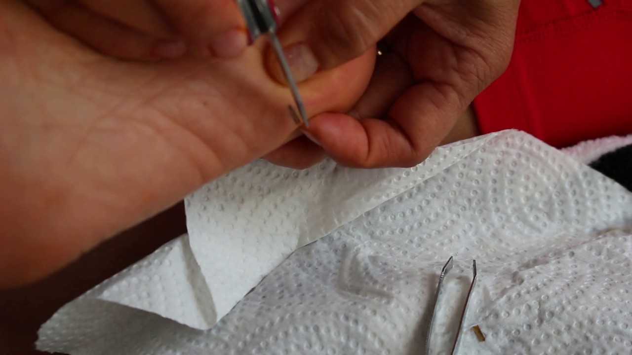 Removing Splinter part 3 - YouTube