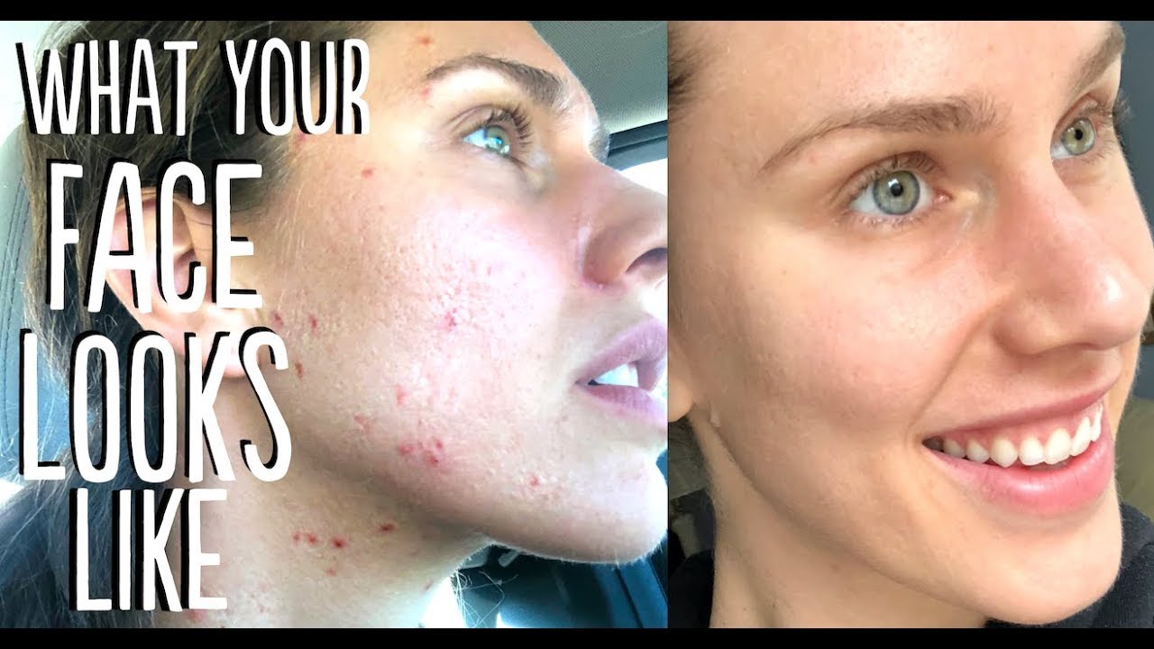 Insecure About Acne... - YouTube