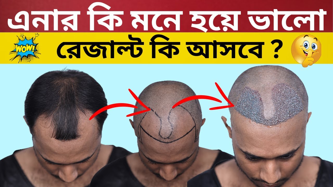 DENSE HAIR LINE RECONSTRUCTION hair transplant in kolkata bangladesh dense-hair-line-reconstruction-hair-transplant-in-kolkata-bangladesh