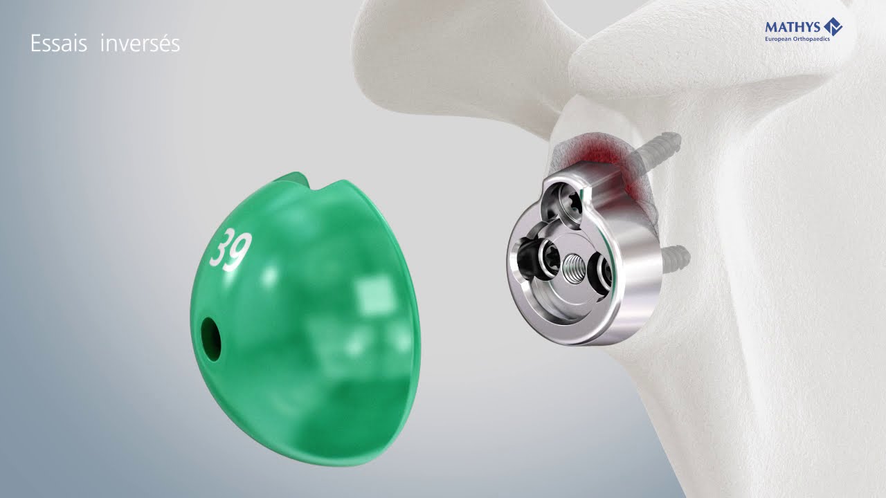 Mathys: Affinis Inverse Prothèse d'épaule inversée système LC avec ...