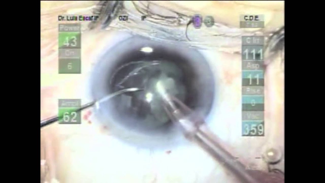 Catarata 5+ Locs III . Mas de 9 fragmentos - YouTube