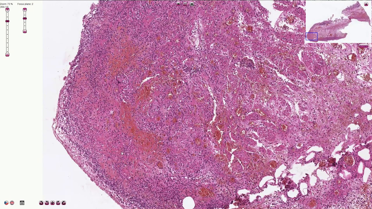 Hemorrhagic Infarction of the Intestine - Histopathology - YouTube