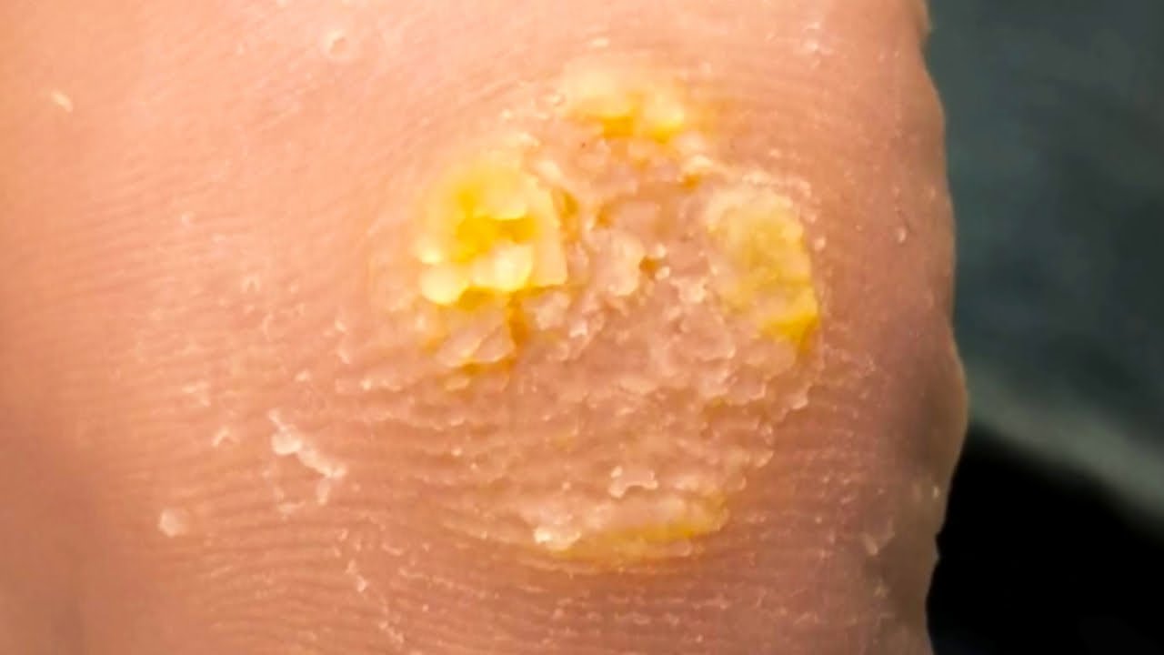 Yellow Calluses On The Feet Fall Like Snowflakes - YouTube