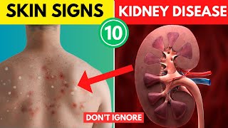Skin Signs Of Kidney Disease