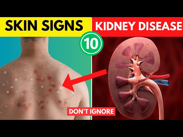 Kidney Disease Skin Symptoms