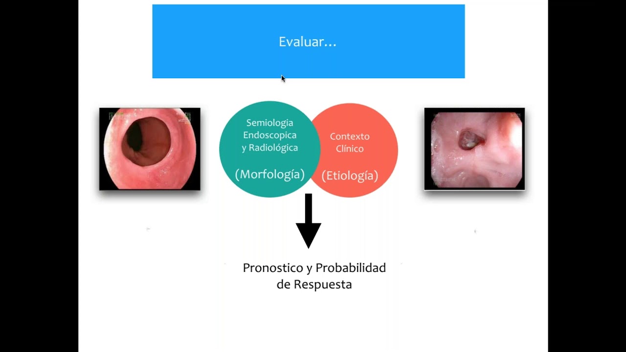 Tratamiento Endoscópico de estenosis esofágica benignas. Dr Sebastian ...