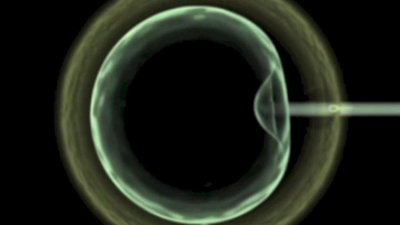 Tecniche PMA - Laser ICSI 3D - GENERA PMA - YouTube