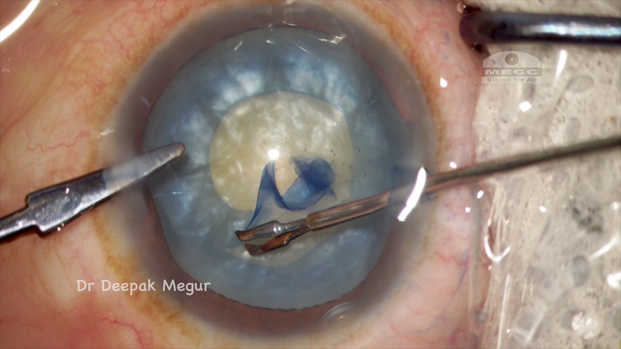 Rhexis Rescue Dr Deepak Megur - YouTube