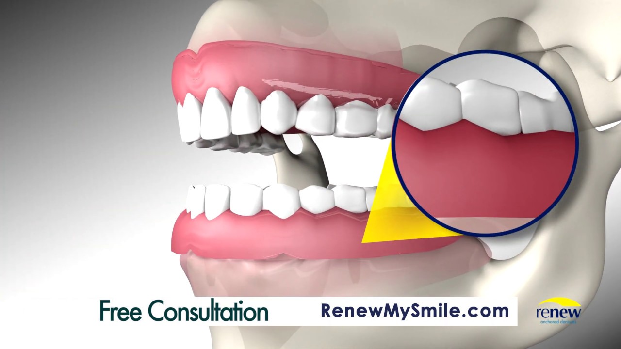 Renew Lifetime Guarantee [Renew Anchored Dentures] - YouTube