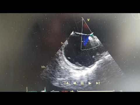 TEE-guided Percutaneous patent foramen ovale occlusion - YouTube