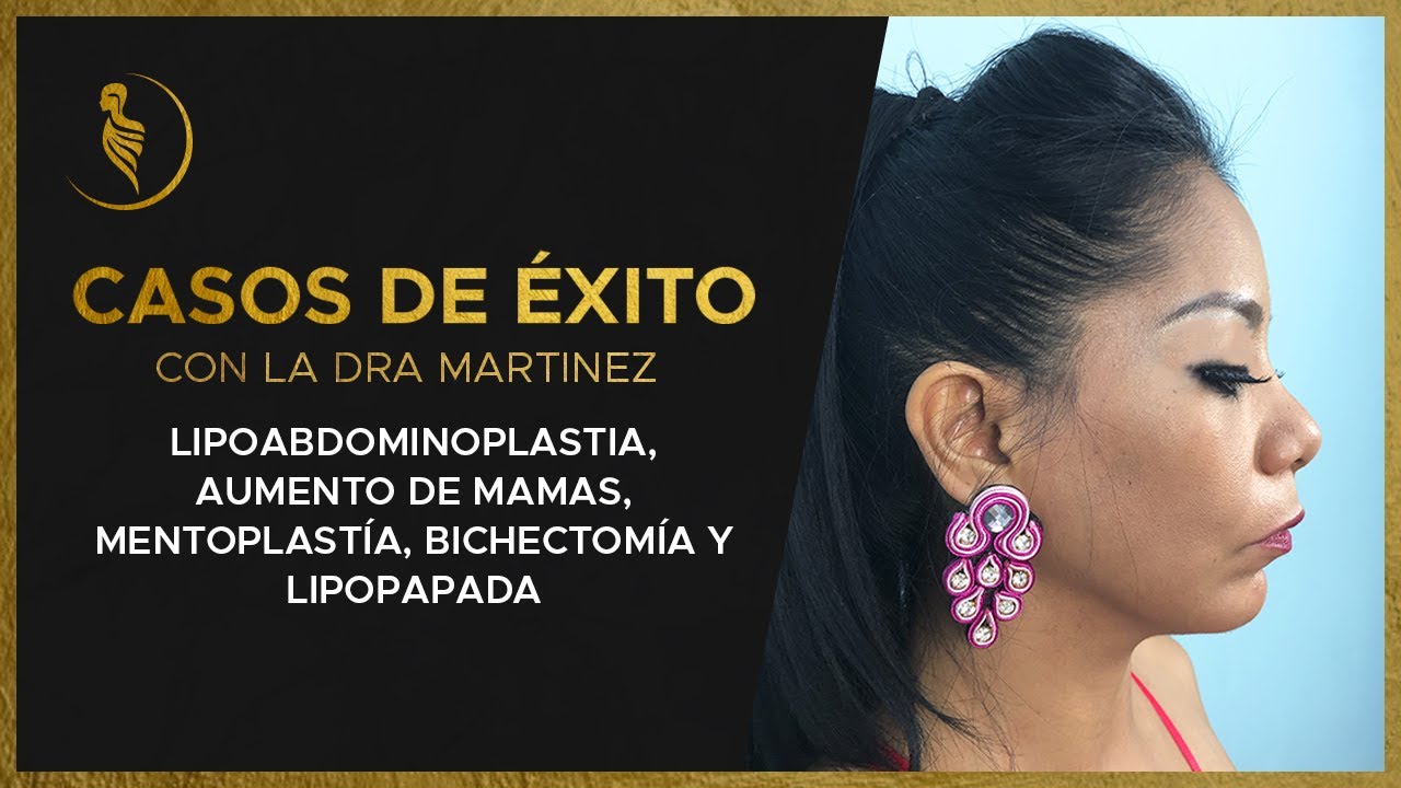 Casos de Éxito: lLipoescultura y Abdominoplastía de Magaly Salgado ...