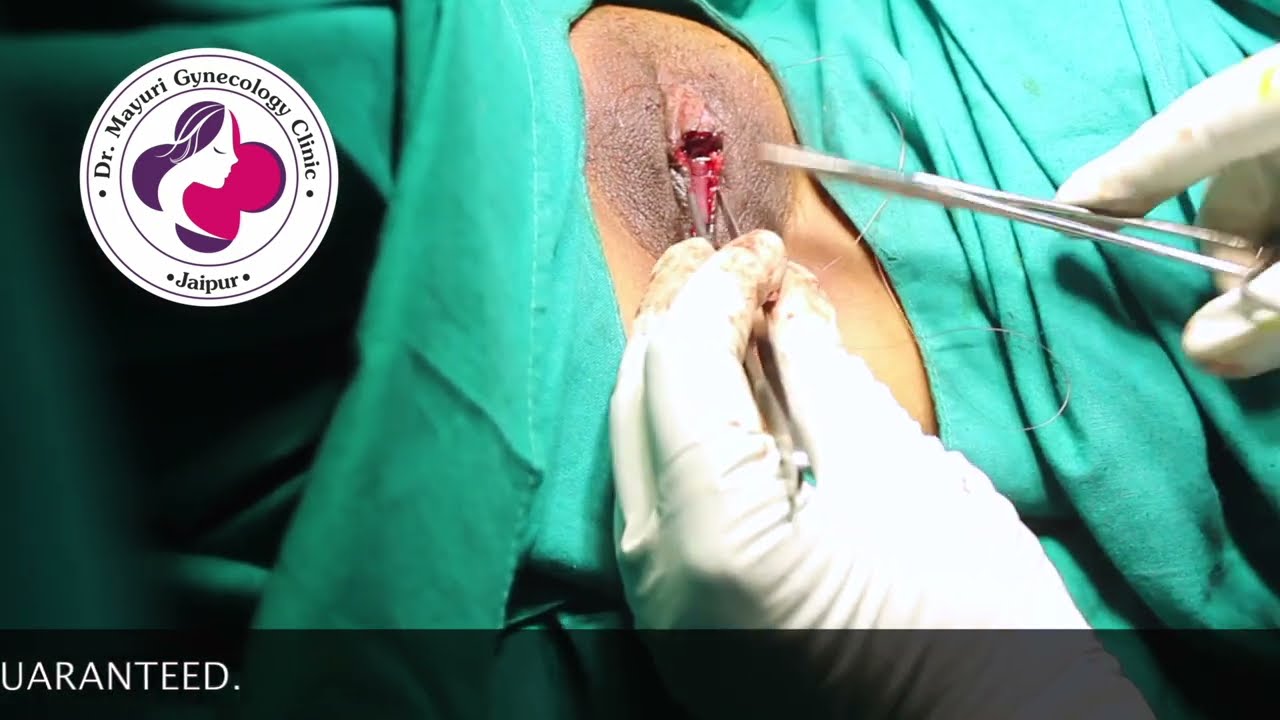 This Is How Labiaplasty Surgery Labia Minora Reduction Is Operated This Is How Labiaplasty Surgery Labia Minora Reduction Is Operated
