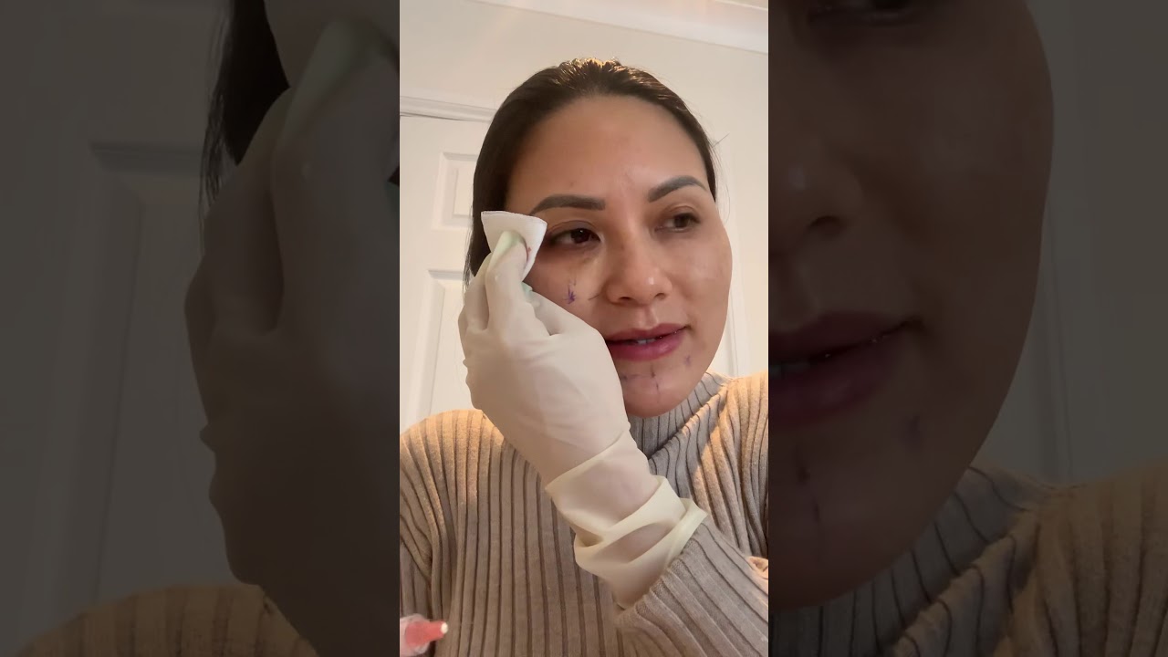 Profhilo 5 points face lifting injection - YouTube