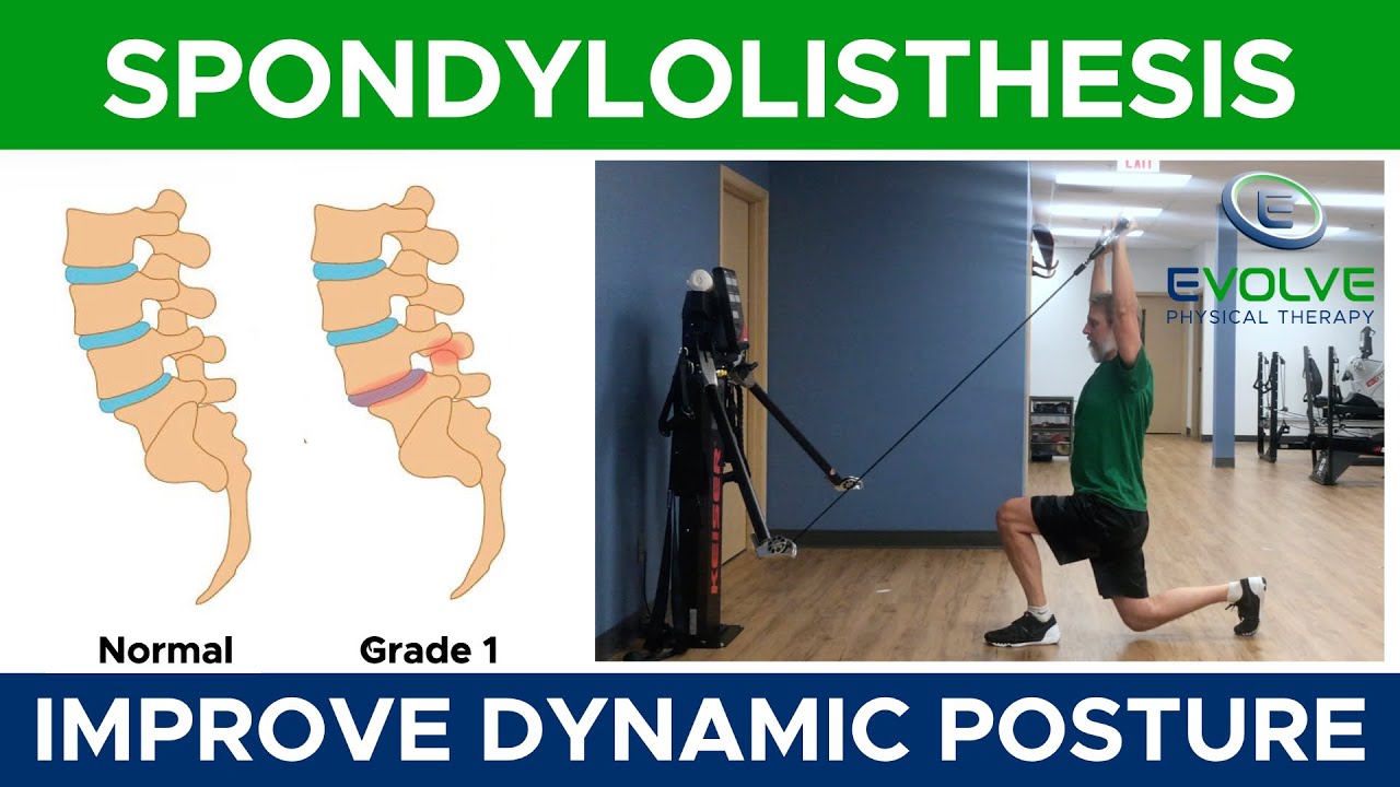 Spondylolisthesis | Exercises To Improve Dynamic Lumbopelvic Stability ...