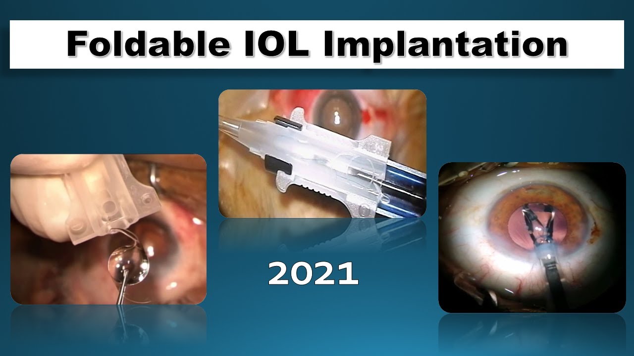 Foldable Intraocular Lens Implantation Basic Phaco 014 YouTube