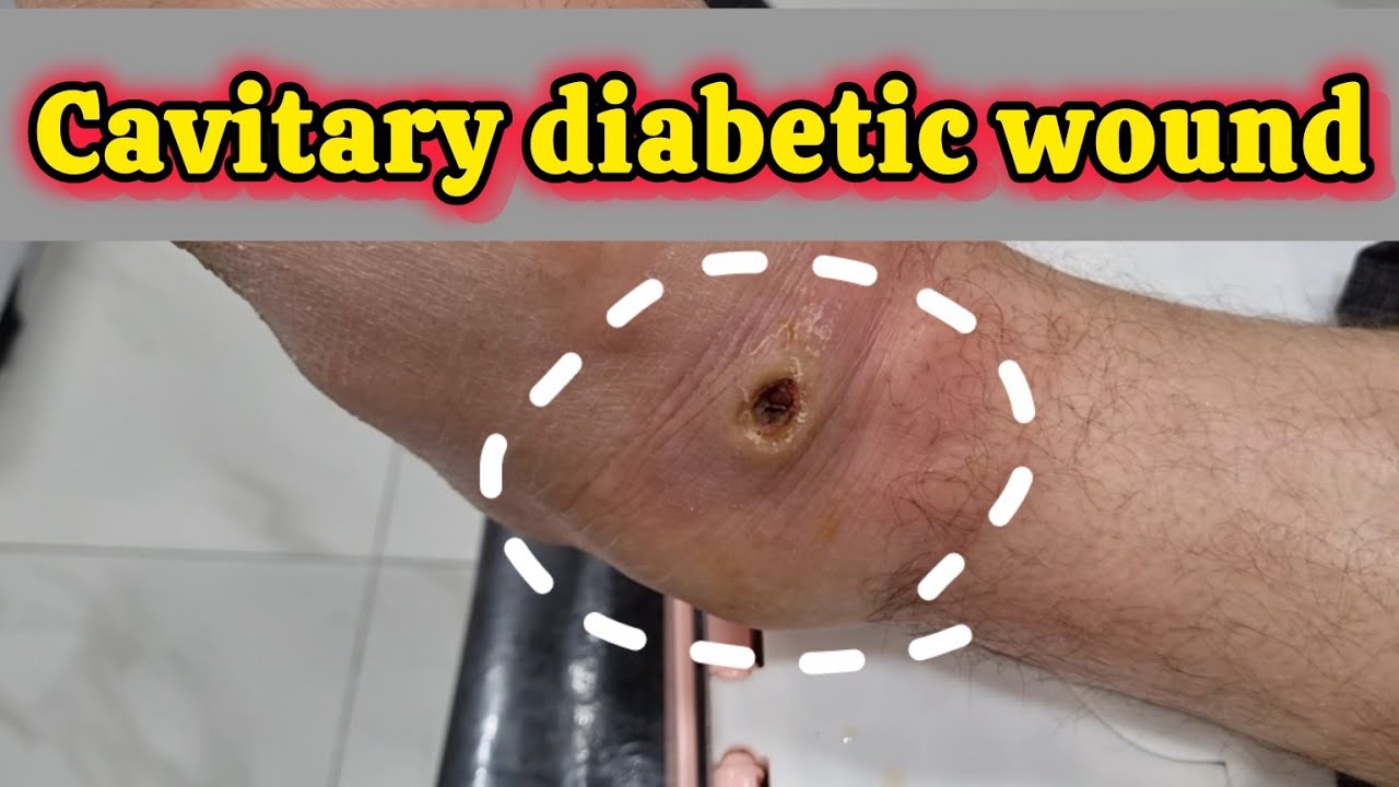 Cavity wound - YouTube