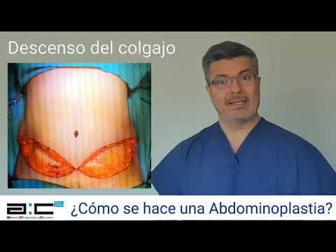 ¿Cómo se hace una Abdominoplastia?