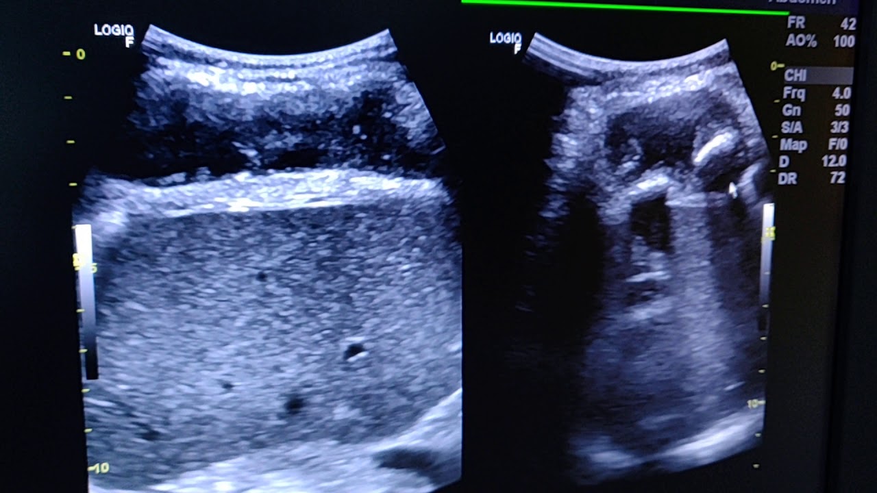 Chest wall Abscess raw(1) - YouTube