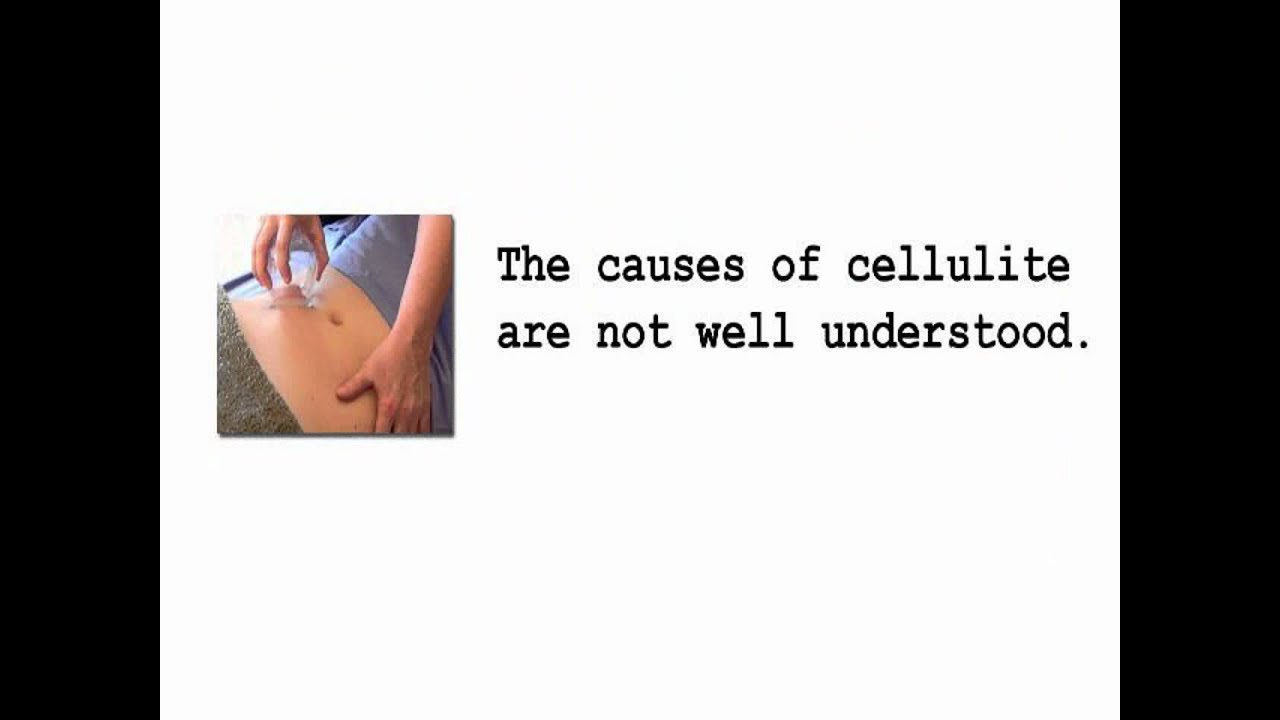 Getting Rid Cellulite - YouTube