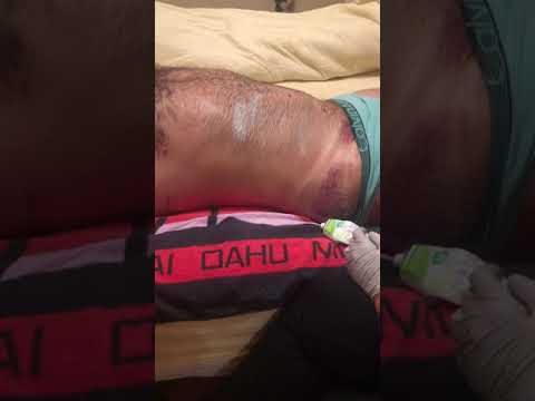 Lymphatic Massage of the lower stomach