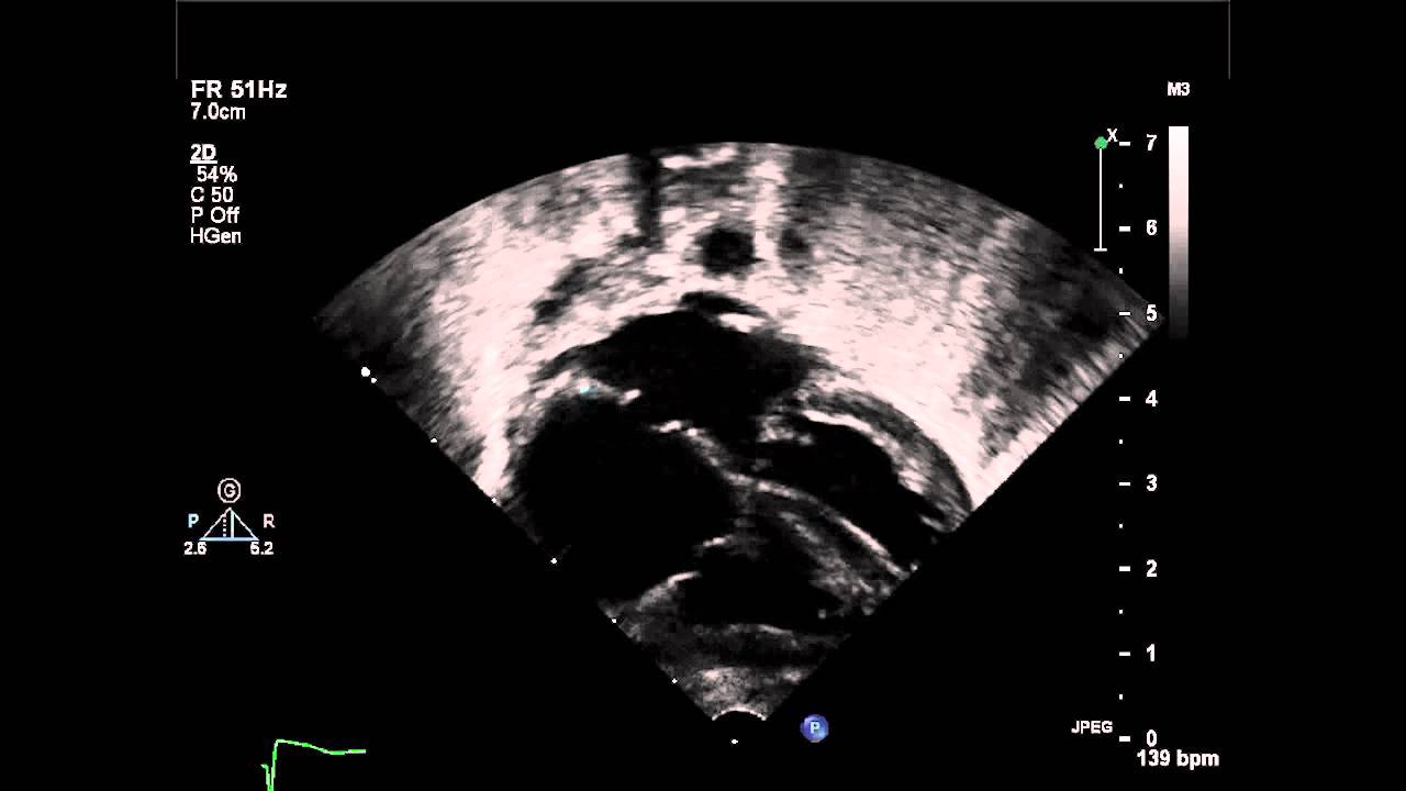 Secundum Atrial Septal Defect Subcostal Coronal 2D - YouTube