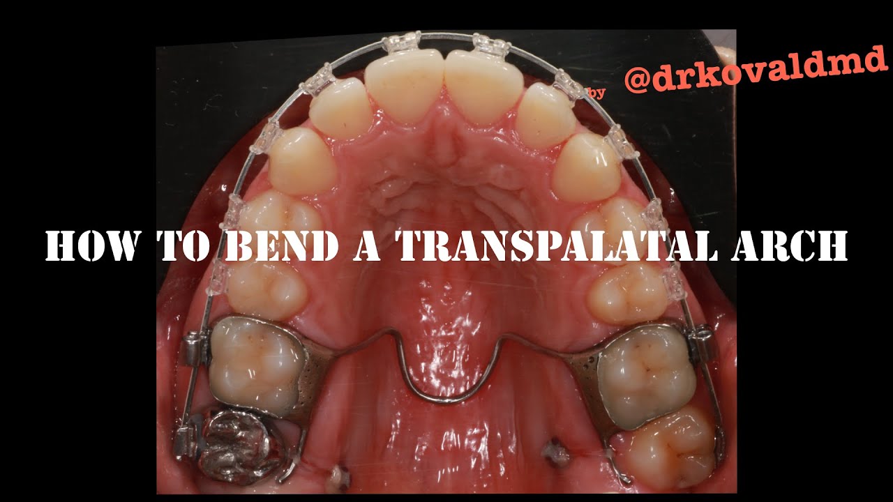 Transpalatal arch (TPA).How to bend and activate a removable TPA ...