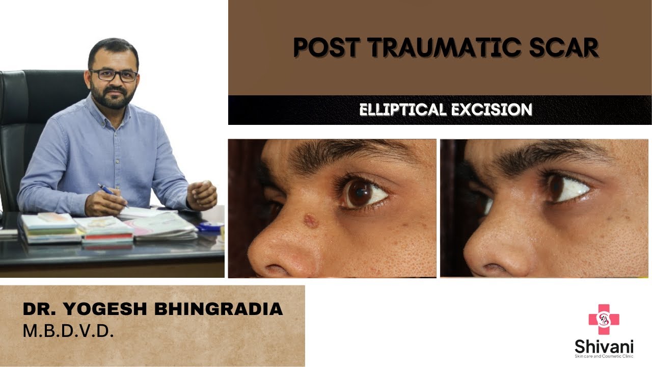 POST TRAUMATIC SCAR | ELLIPTICAL EXCISION | SCAR REVISION | DR YOGESH ...
