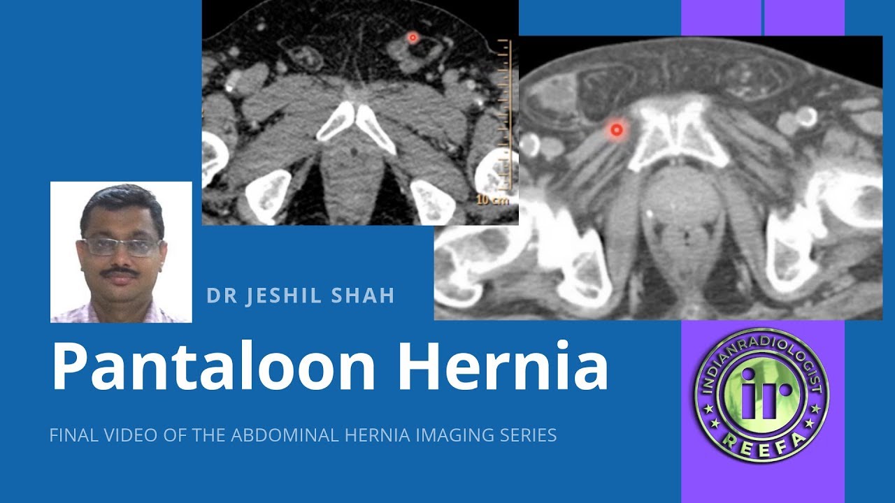 TMT: Pantaloon Hernia by Dr Jeshil Shah - YouTube