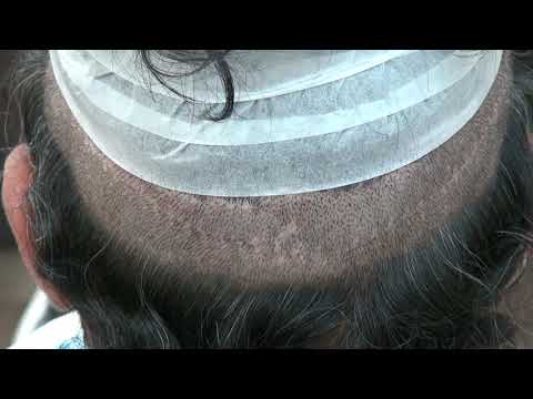 Example of the FUT Hair Transplant Strip Harvesting Method Scar with Dr ...