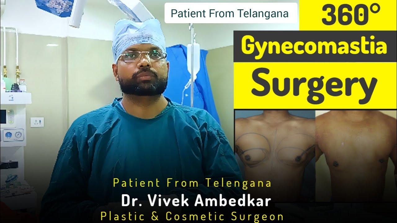 360° Gynecomastia Surgery | Liposuction Gland Removal | Chest Excercise ...