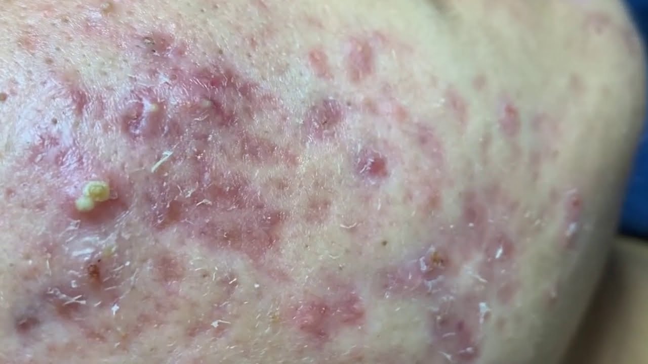 Blackheads Removal by Cystic acne removal | Satisfying Pimple Popping ...