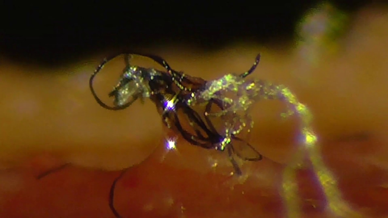 #548 - Pulling OUT Alien Morgellons ~ Interesting Wound Landscape - YouTube
