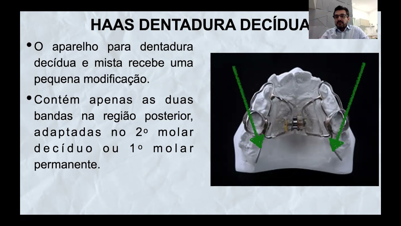 Expansão Rápida da Maxila, Parte 1- Haas - YouTube