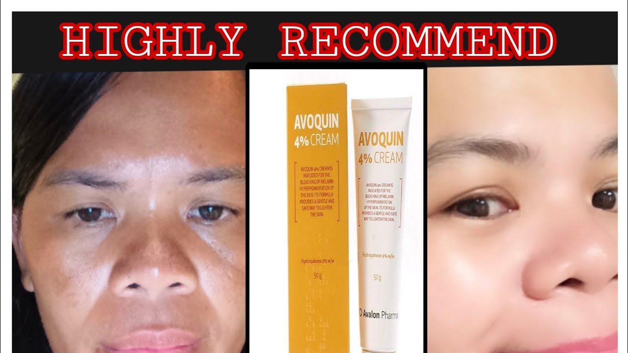After 2 Months ng Paggamit ng Avoquin 4% Cream / Pekas Solution # ...
