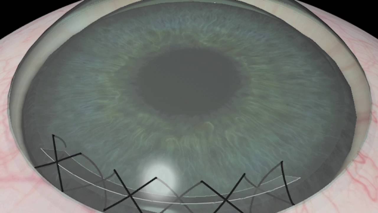 Bootlace suture dv settings 1 - YouTube