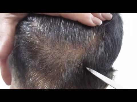 Trichophytic closure by Neopel