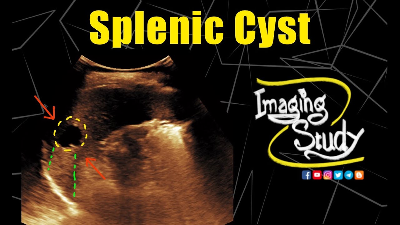 Splenic Cyst || Ultrasound || Case 312 - YouTube