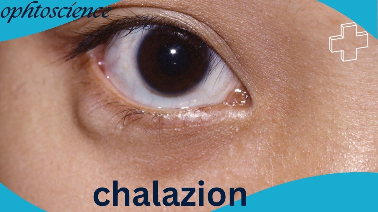 what is chalazion? Red bump on eyelid|symptoms |complications ...