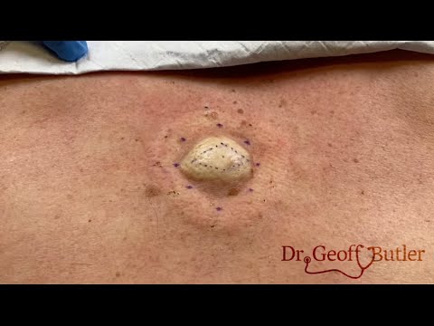 Removal of Epidermal Cyst on Back - YouTube