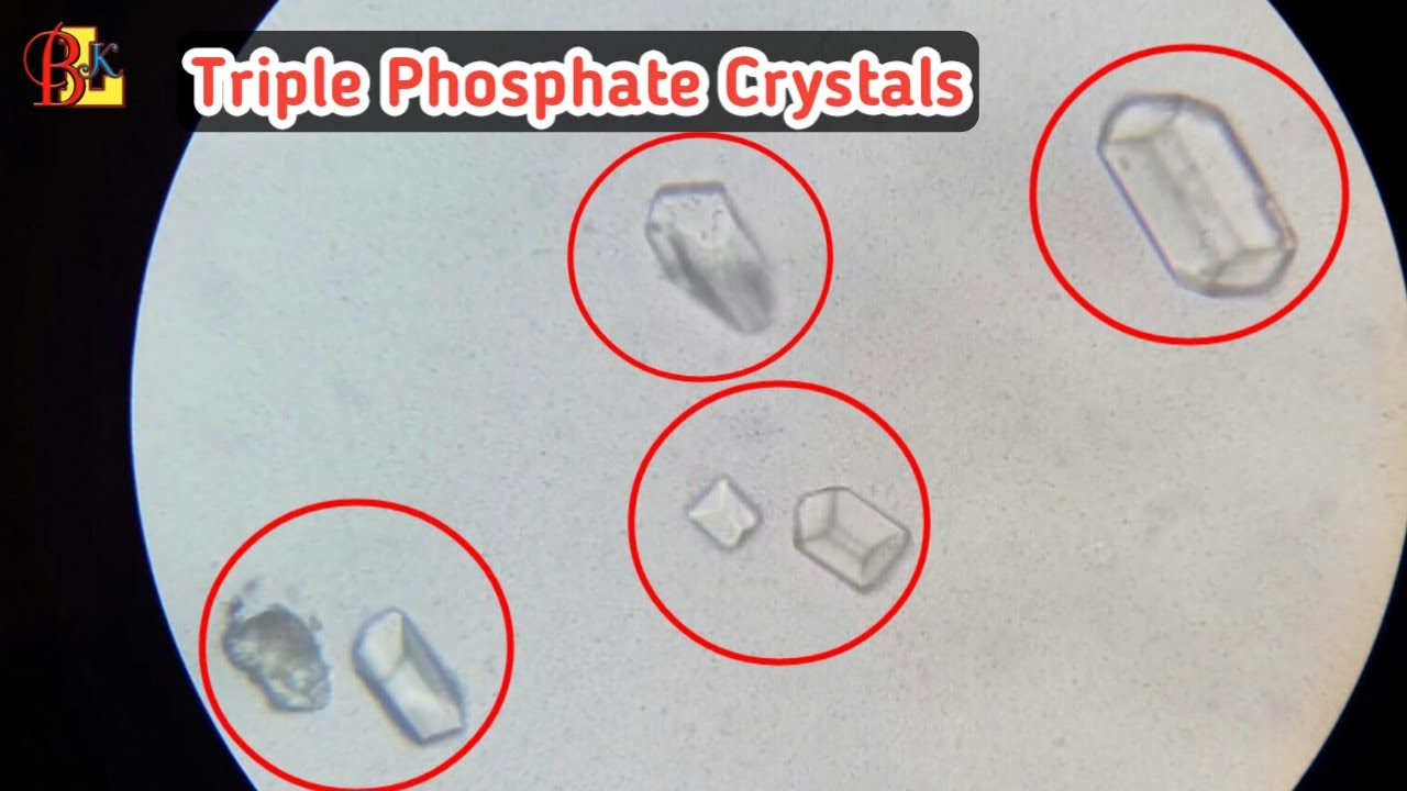 Triple Phosphate Crystals in Urine - YouTube