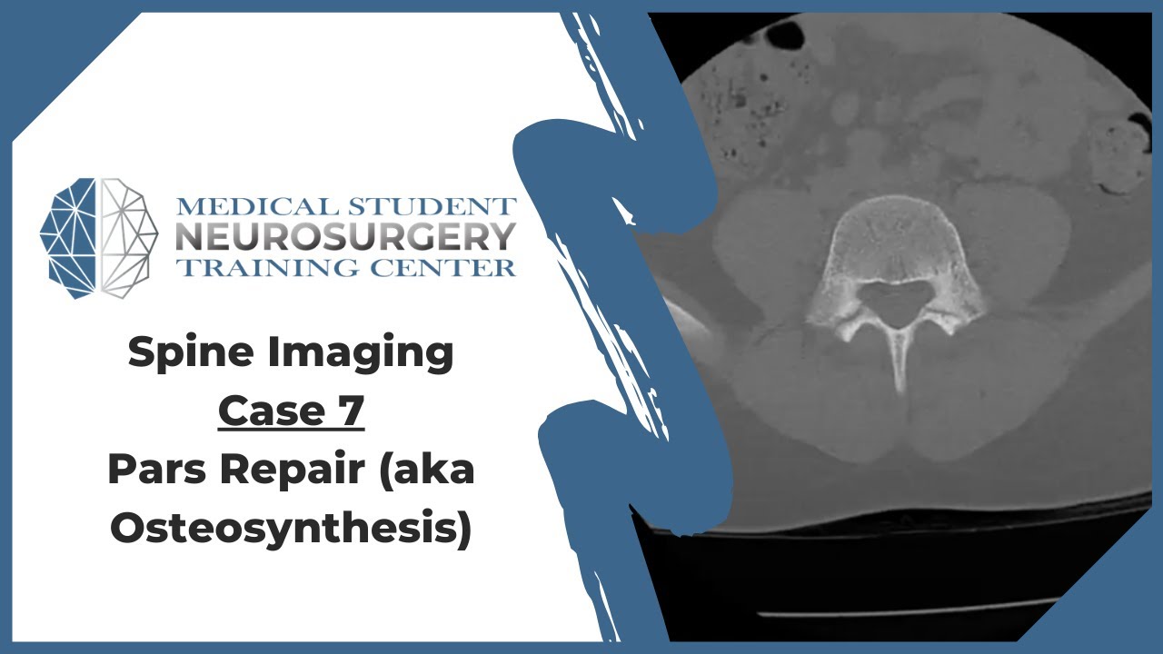 Spine Imaging Case 7 Pars Repair (aka Osteosynthesis) - YouTube