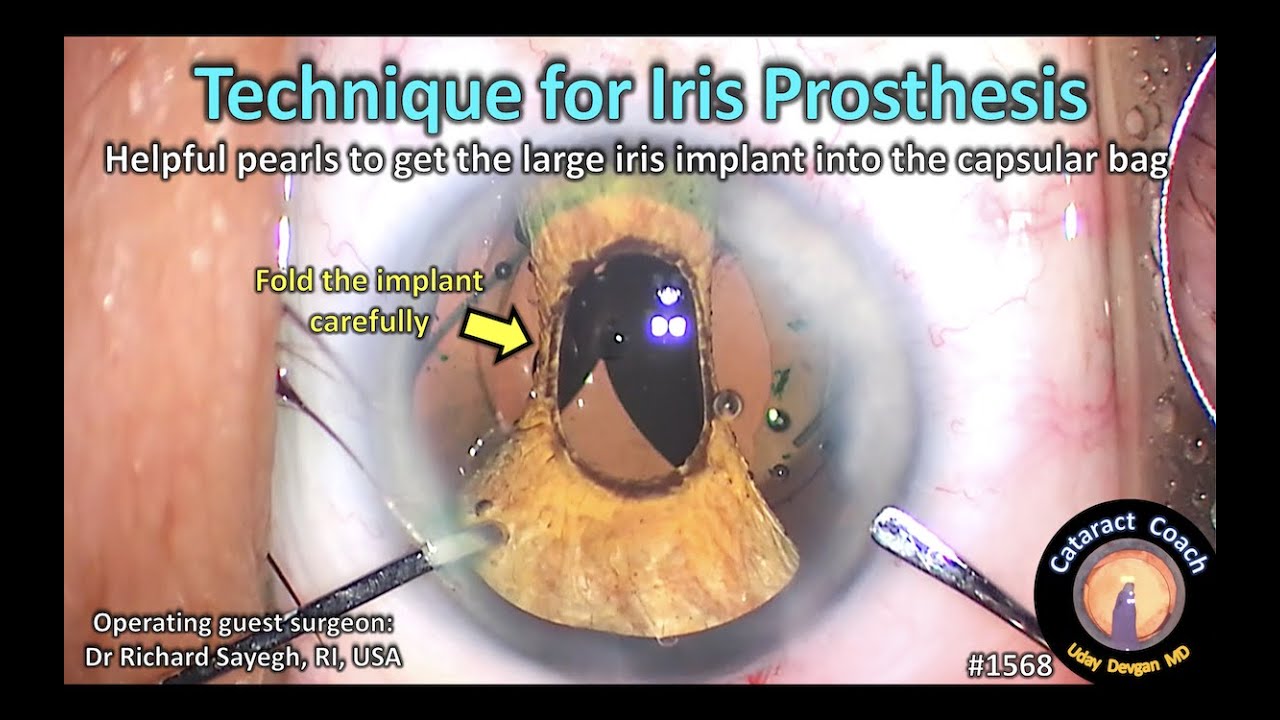 CataractCoach 1568: technique for artificial iris prosthesis - YouTube