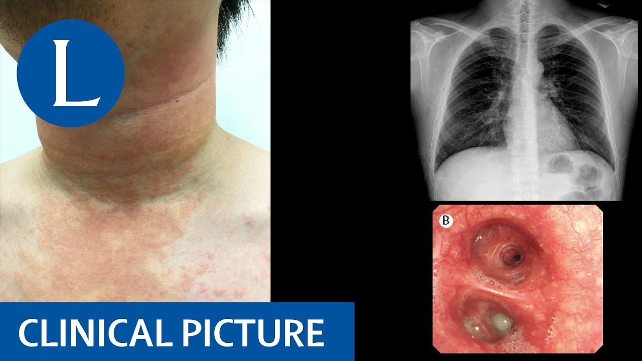 Repeated tear gas exposure associated with allergic dermatitis ...
