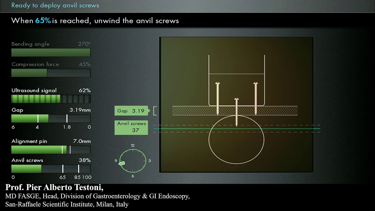 MUSE procedure by Prof. Pier Alberto Testoni - San Raffaele Hospital ...