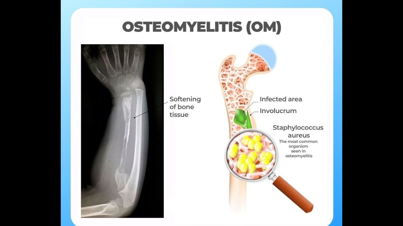 Pathology of osteomyelitis ; Definition, Etiology Oranisms involved ...
