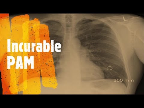 Pulmonary alveolar microlithiasis | pam | PAM | stone in lungs | rare ...