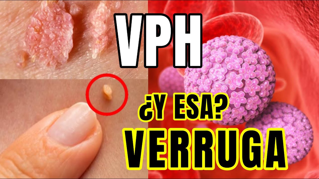 Virus del Papiloma Humano (VPH) | Verrugas genitales, Síntomas, Cáncer ...