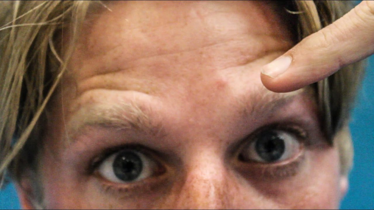 MASSIVE PIMPLE - YouTube
